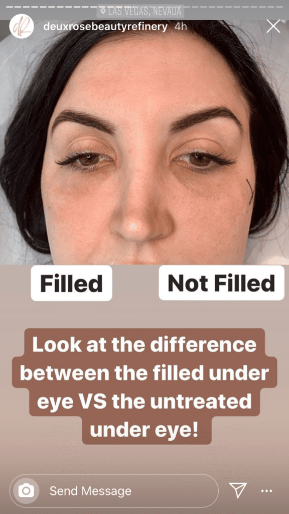 RHONJ's Ashlee Holmes Gets Full Face of Filler - See Her Before and ...