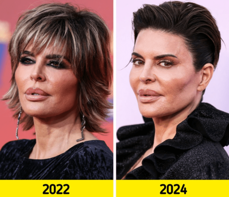 Lisa Rinna Bares All On Insta After Dissolving Face Fillers
